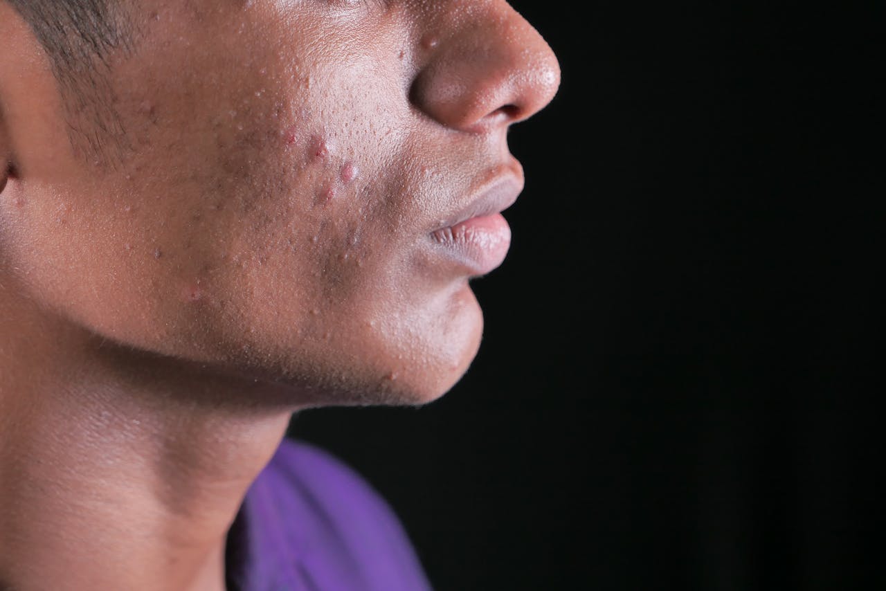 How Does Drug Abuse Affect Skin Health | Harmony Ridge Recovery Center